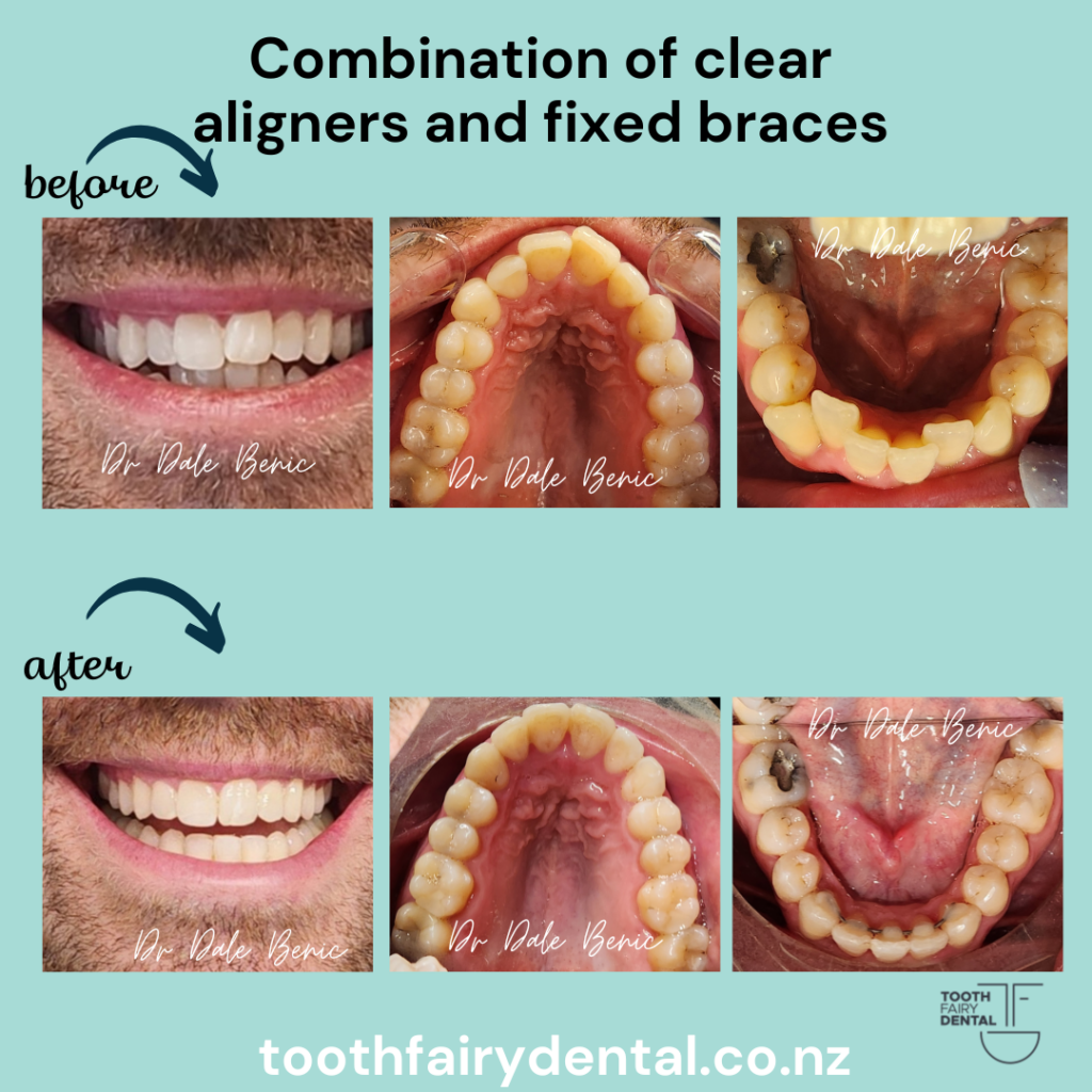 Clear aligners - Tooth Fairy Dental